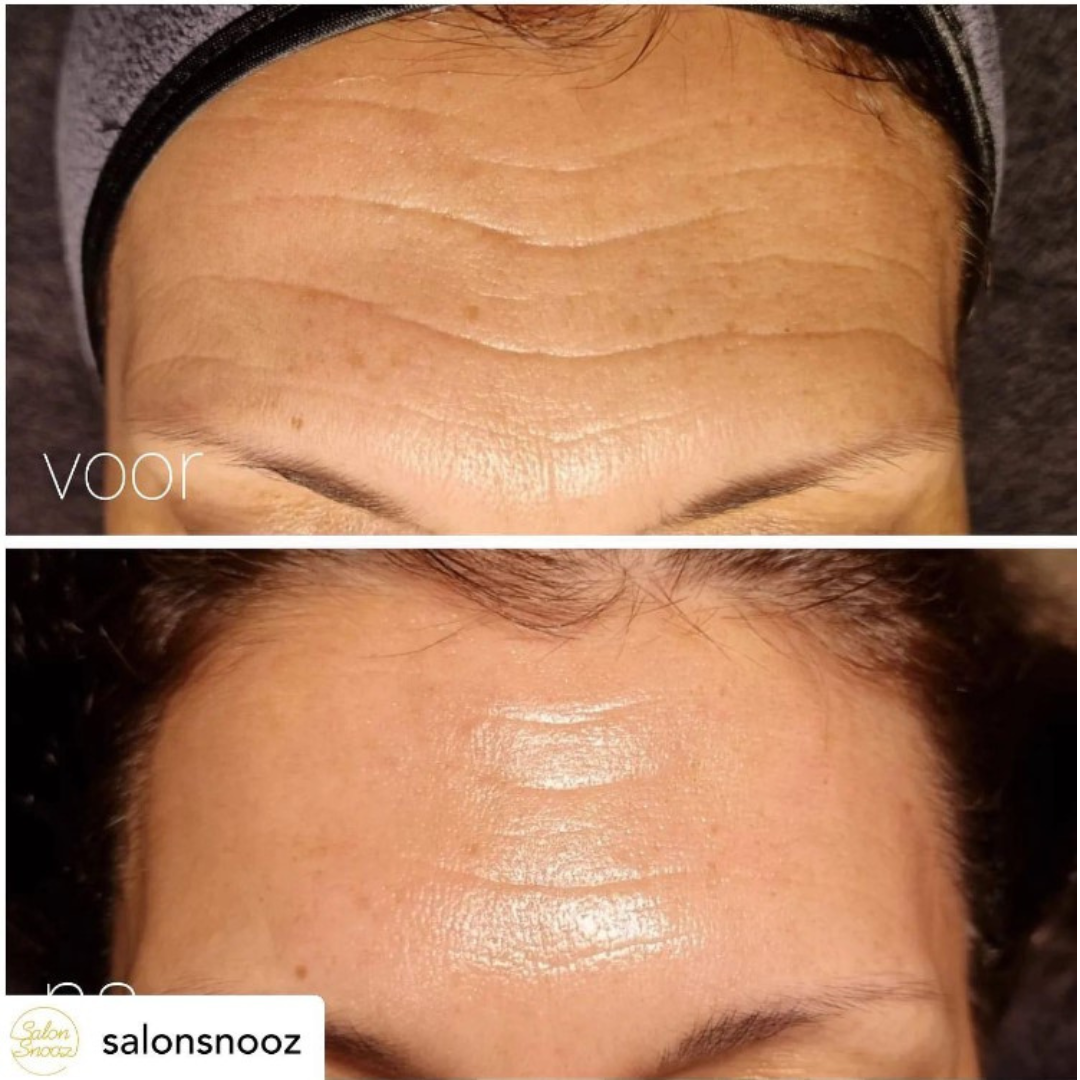 KRX Carboxy kezelés - CO2 (Mini szett) | LONDON BEAUTY PRO.